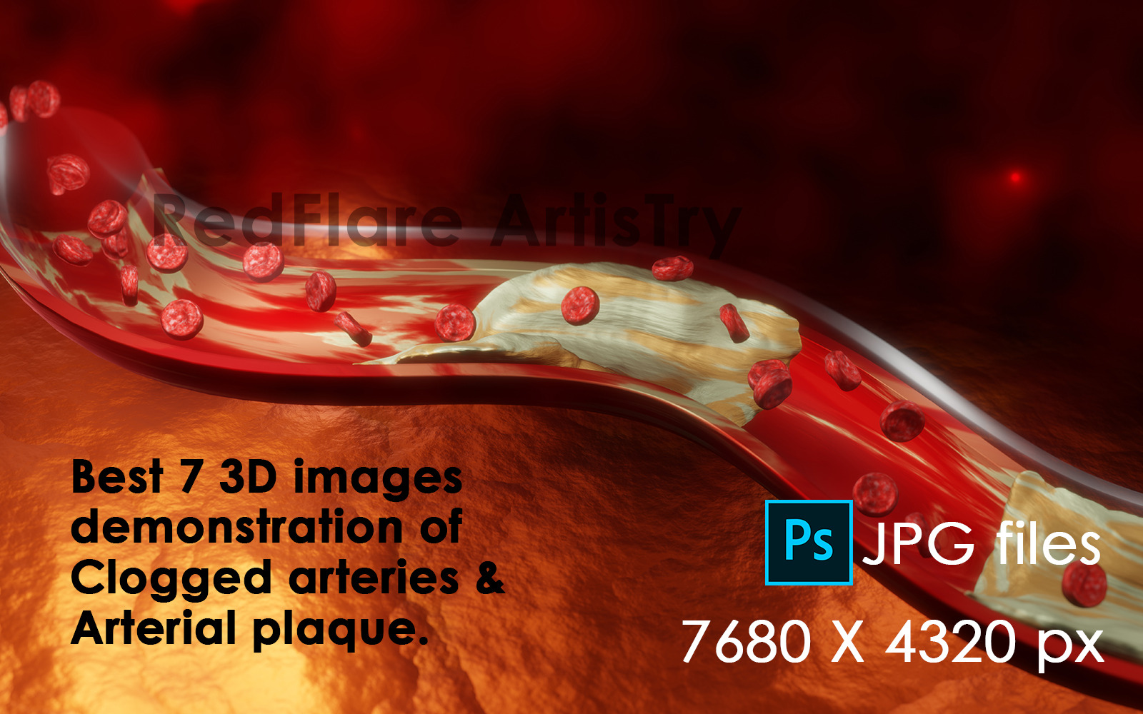 Best 7 High Resolution 3D Images Of Clogged Arteries And Arterial ...